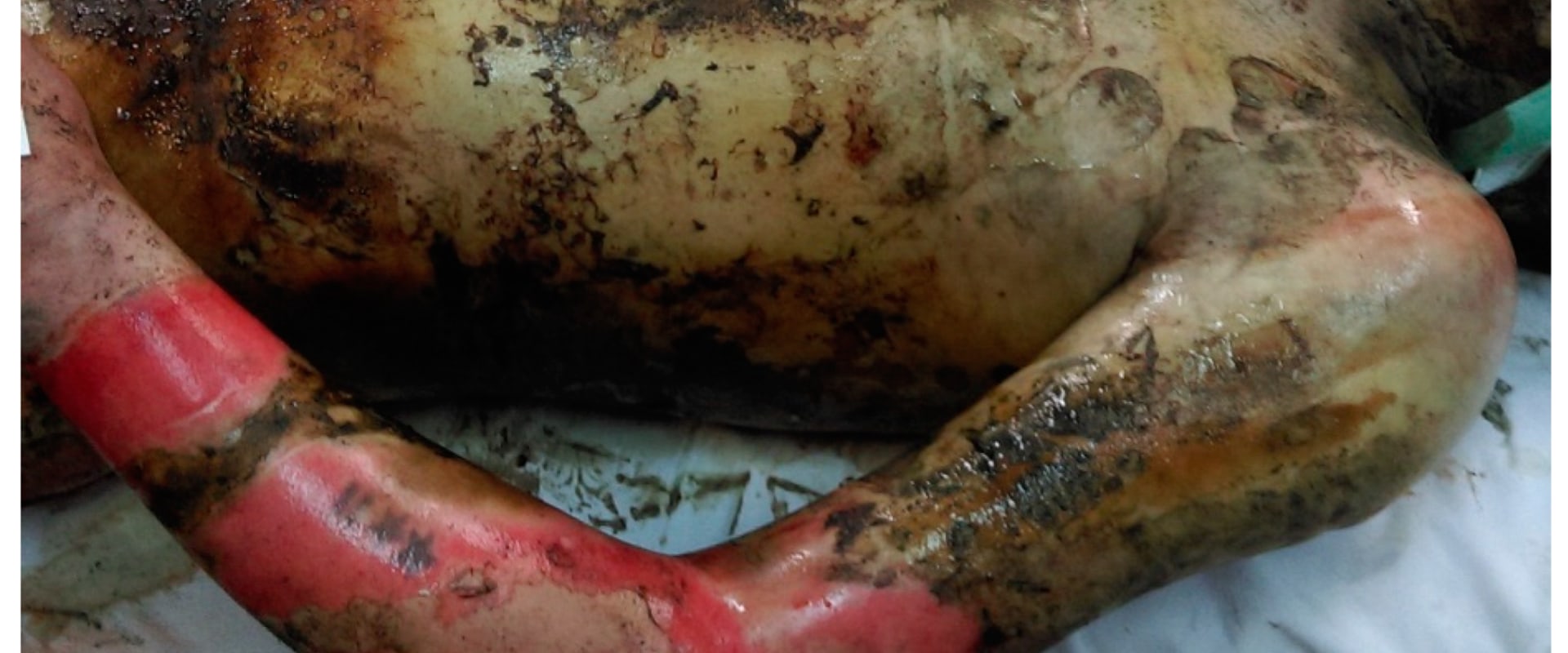 The Four Stages of Burns: Understanding the Severity and Treatment