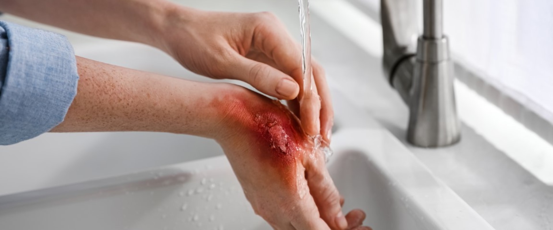 Understanding the Severity of Fifth-Degree Burns