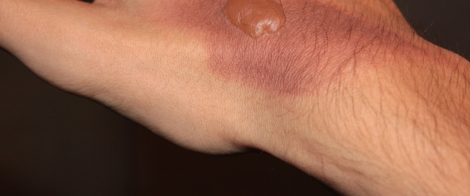 The Different Degrees of Burns: A Comprehensive Guide to Understanding ...