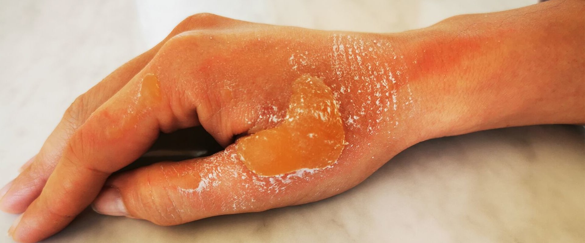 Understanding the Different Degrees of Burns: An Expert's Perspective
