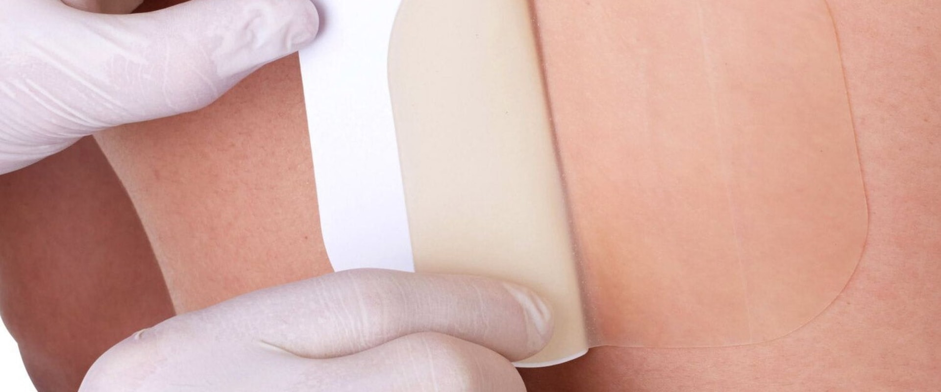 The Best Hydrocolloid Dressing Examples for First-Degree Burn Recovery