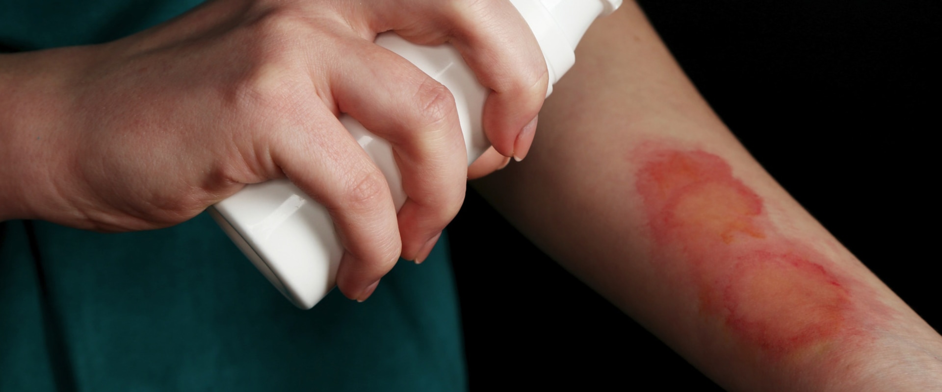 The Denuded Skin Wound Meaning You Need to Know When Treating First ...