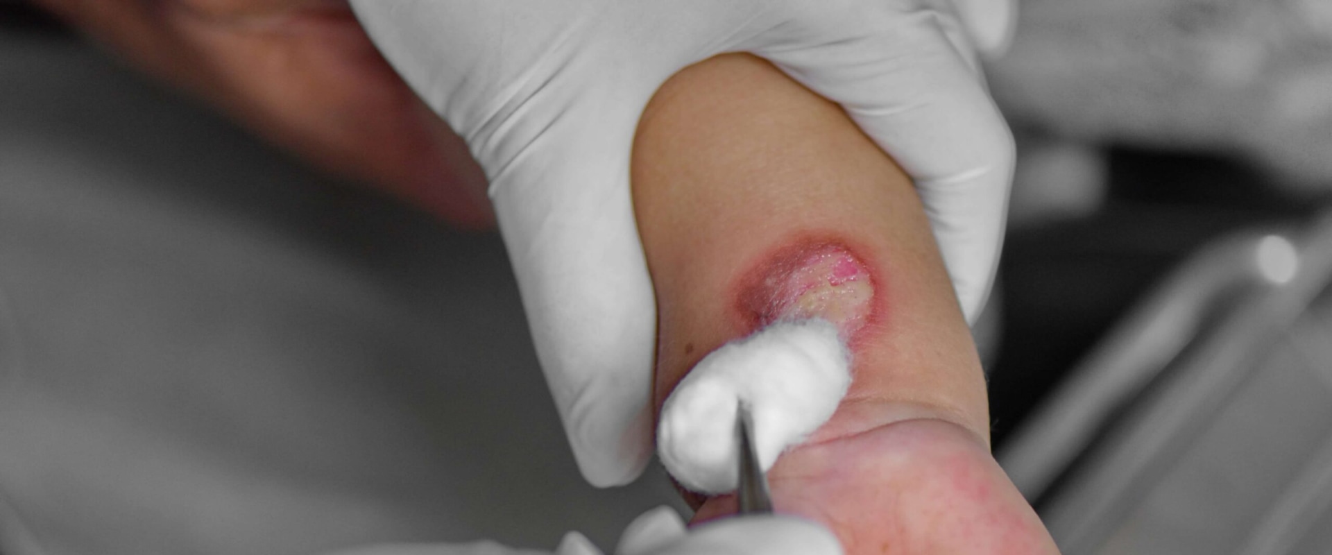 Essential Knowledge On First Degree Chemical Burn Stages For Quick Recovery