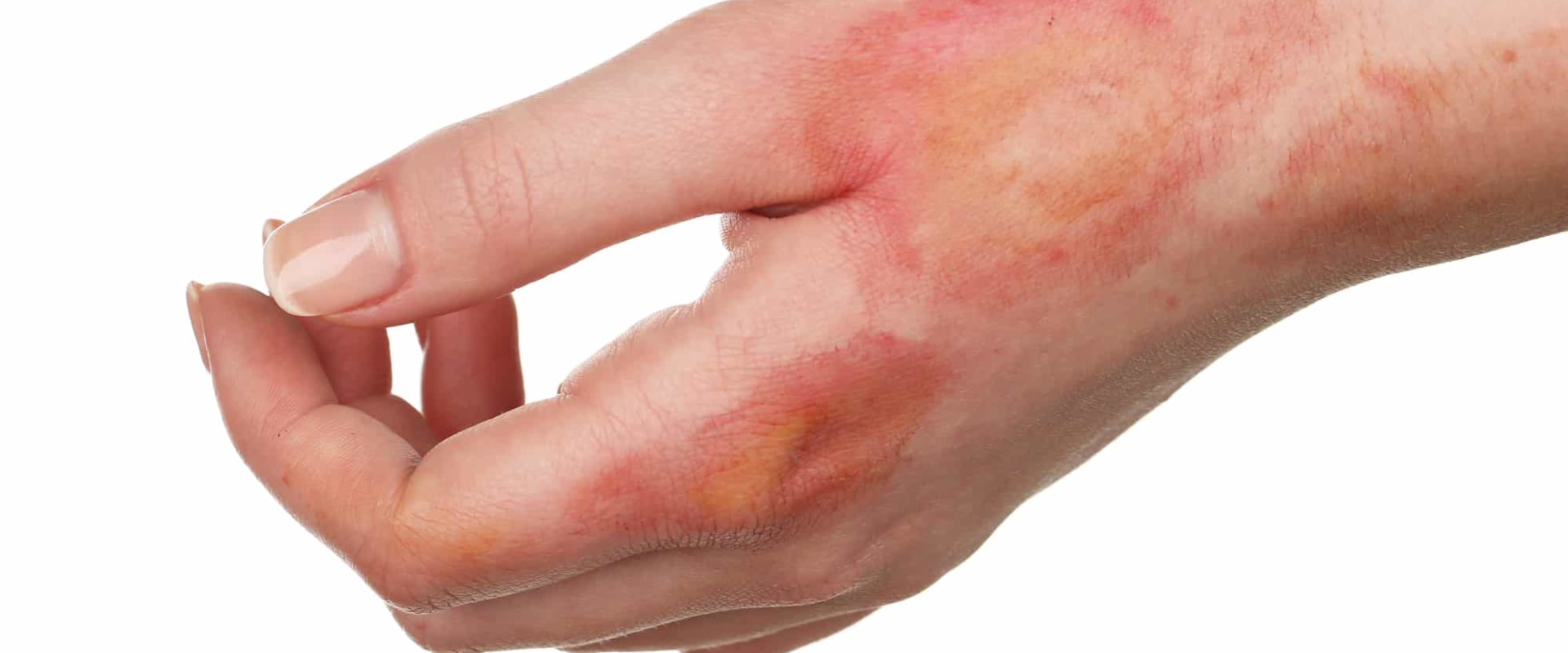 Burn Degree Chart and Guide: Identify Burn Stages & Treatment