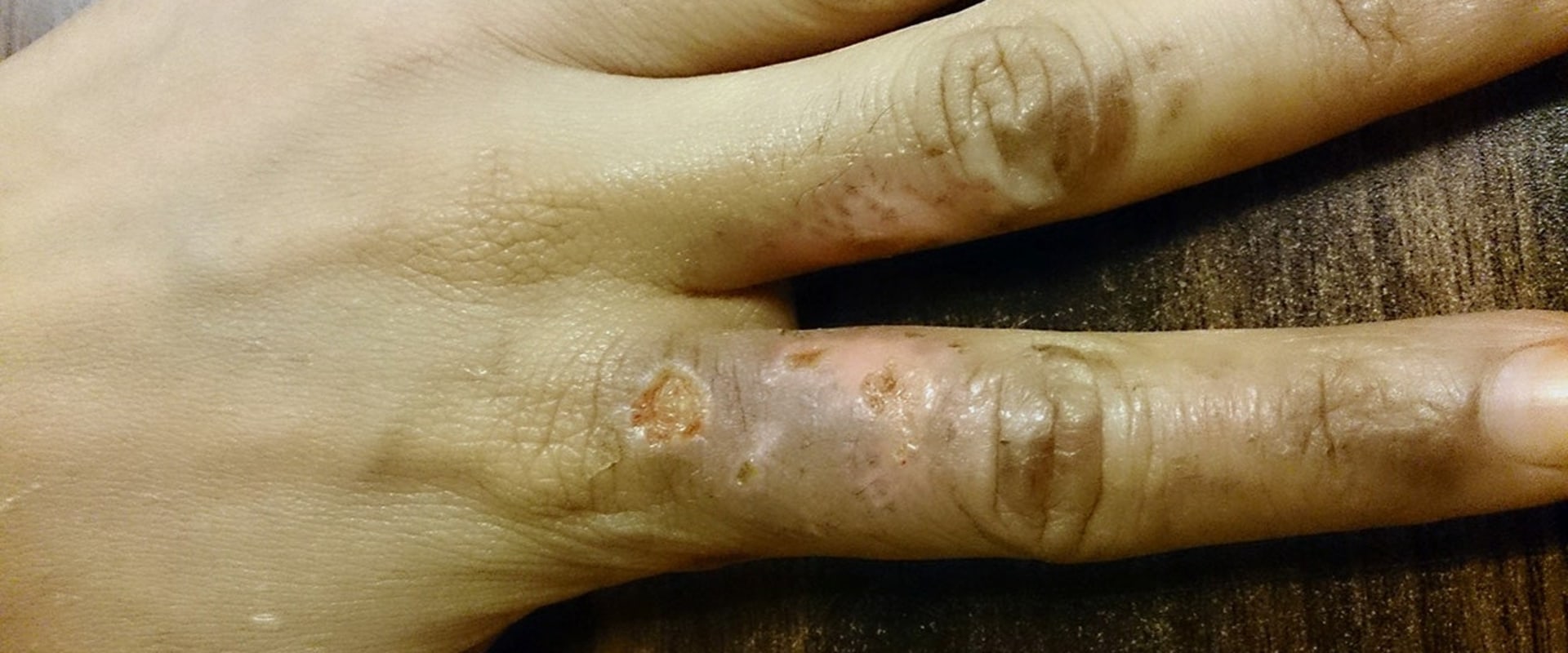 The Different Degrees of Burns: Understanding the Severity and Treatment